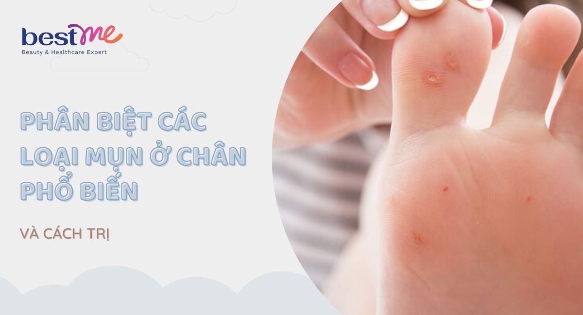 Phân biệt các loại mụn ở chân phổ biến nhất và cách trị