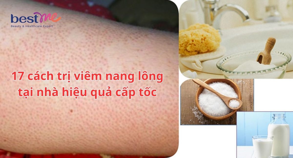 17 cách trị viêm nang lông tại nhà hiệu quả cấp tốc ngỡ ngàng