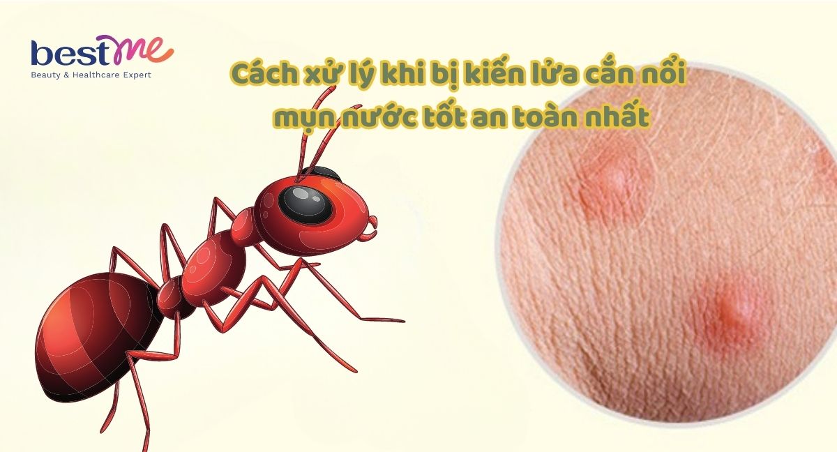 Cách xử lý khi bị kiến lửa cắn nổi mụn nước tốt an toàn nhất