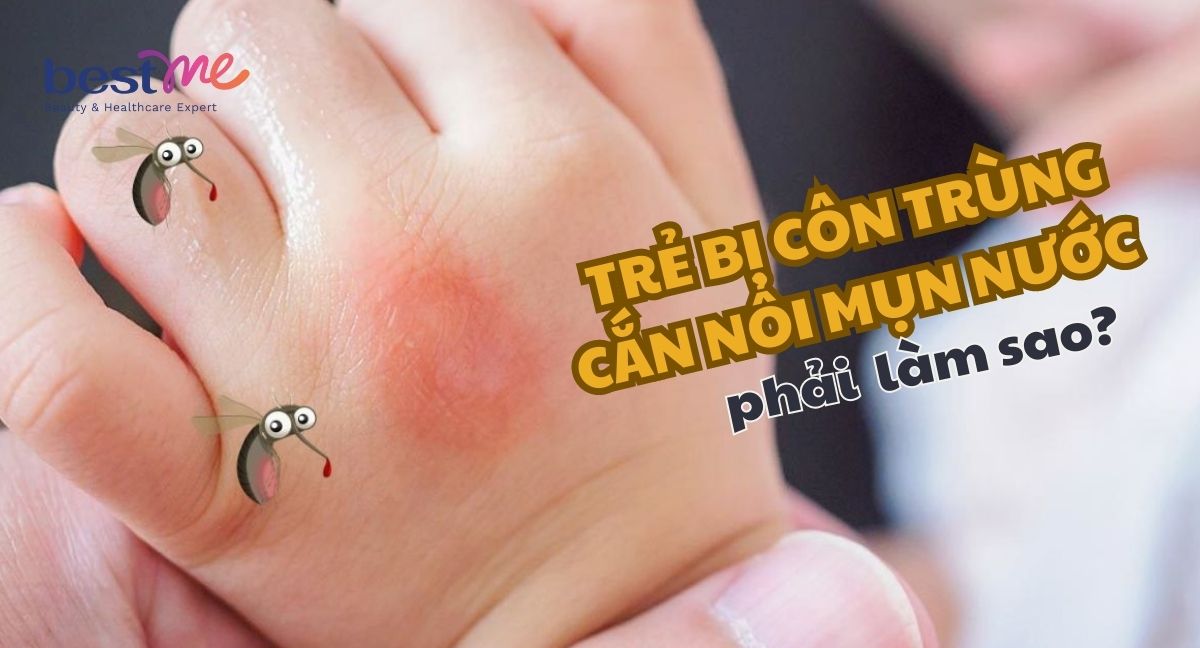 Trẻ Bị Vết Côn Trùng Cắn Nổi Mụn Nước Bóng Nước Phải Làm Sao