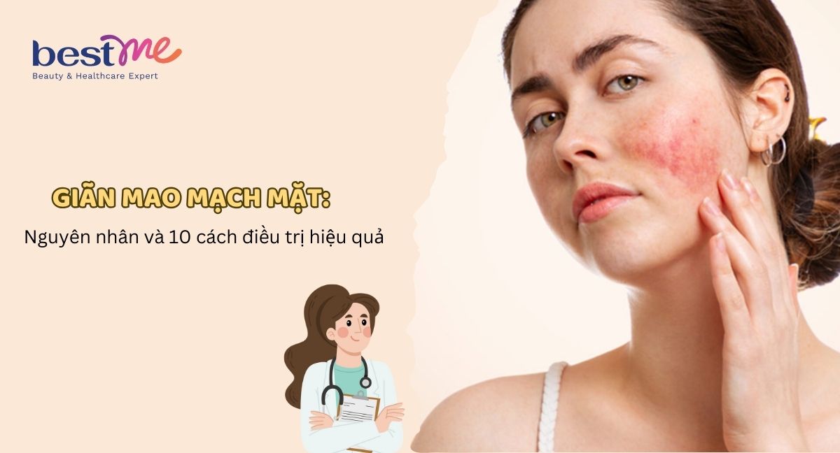 Nguyên nhân bị giãn mao mạch mặt và cách chữa hiệu quả nhất