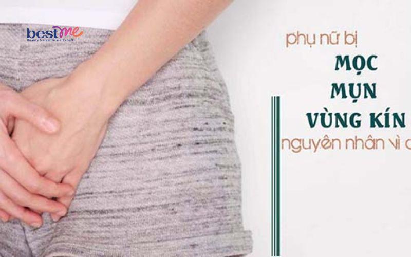 Vì sao mọc mụn trứng cá ở vùng kín? Cách điều trị hiệu quả