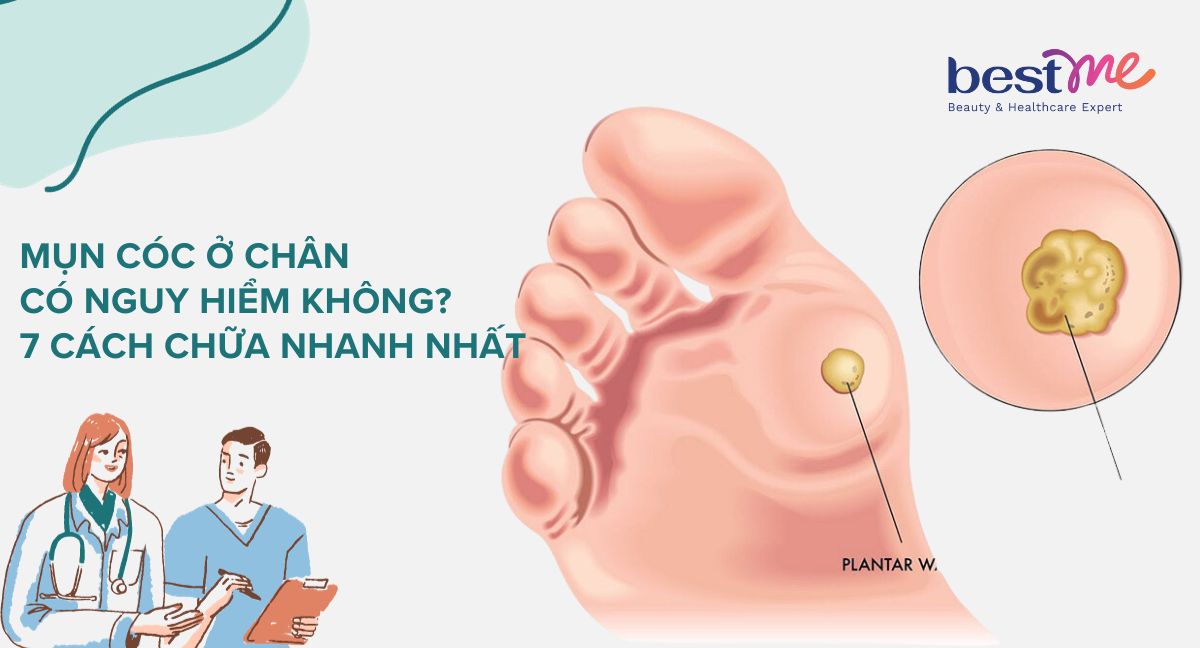 Mụn cóc ở chân có nguy hiểm không? 7 cách chữa nhanh nhất