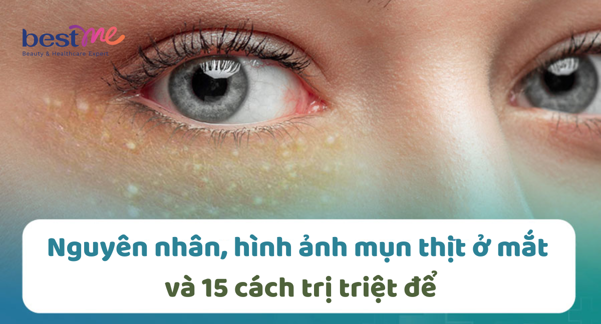 Nguyên nhân, hình ảnh mụn thịt ở mắt và 15 cách trị triệt để