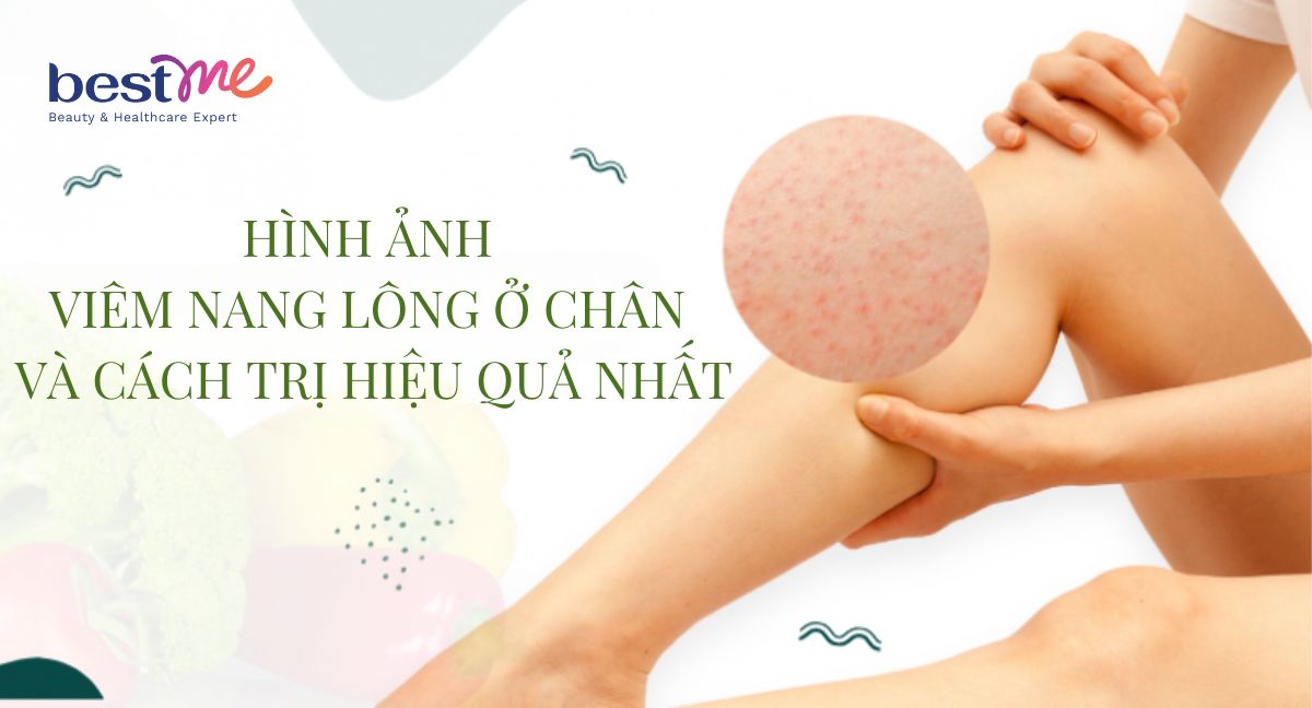 Hình ảnh viêm lôc chân lông ở chân và cách trị hiệu quả nhất